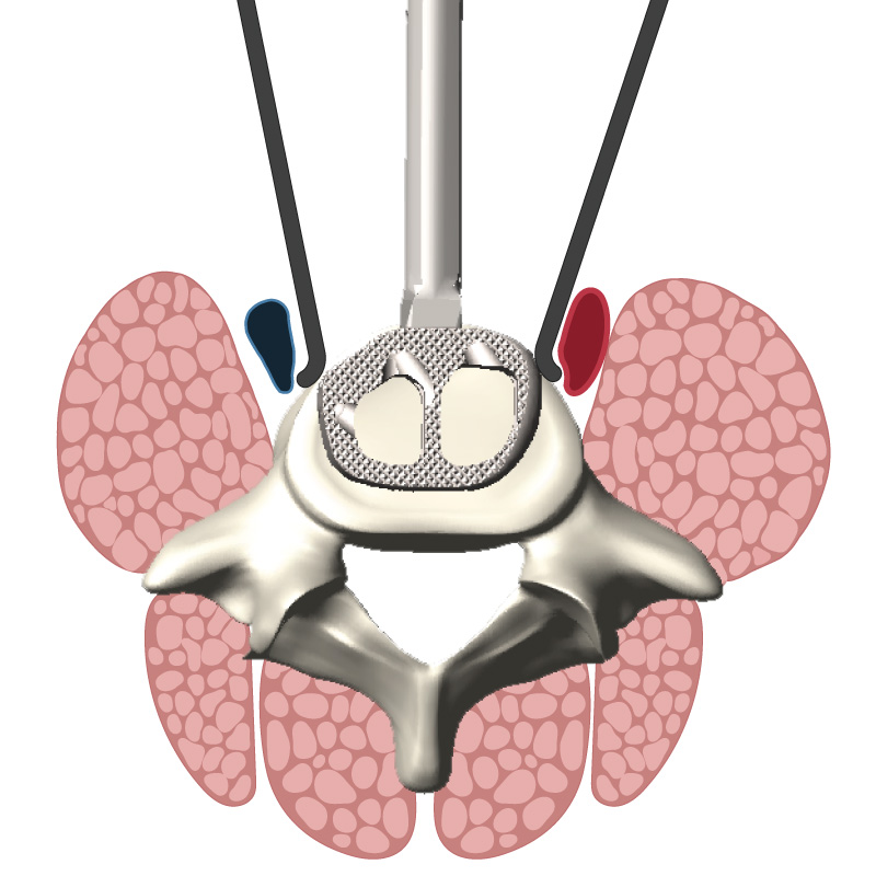 OneLIF Enabling Technology | NovApproach Spine